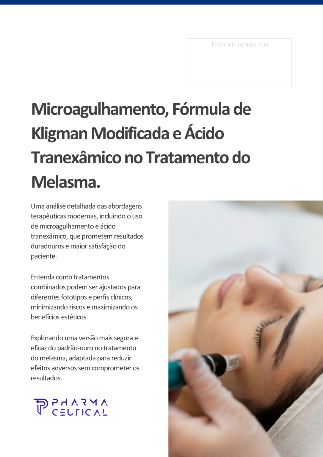 Microagulhamento, Fórmula de Kligman Modificada e Ácido Tranexâmico no Tratamento do Melasma ...
